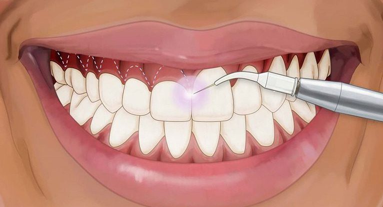 Sharon Needles Teeth Fixed